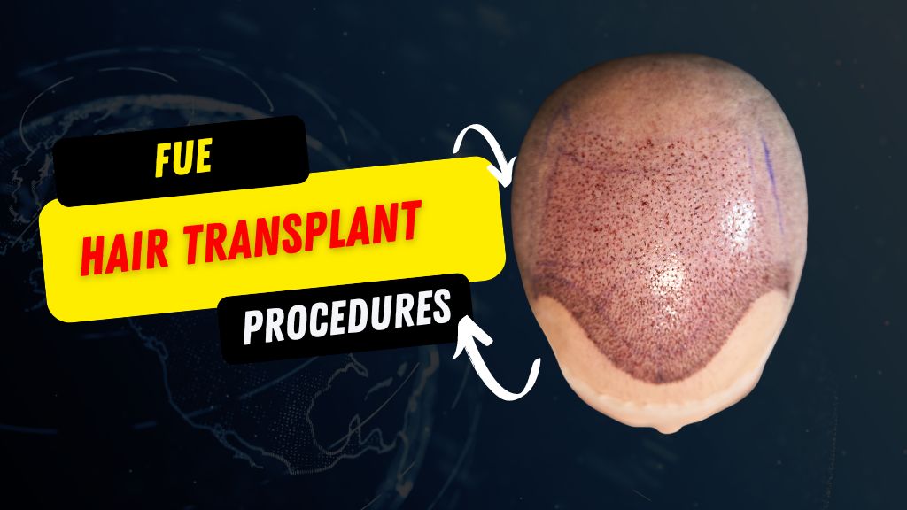 Understanding the Intricacies of FUE Hair Transplant Procedures